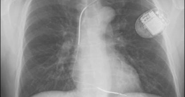 Dual chamber defibrillators pose higher risk of complications | CU ...